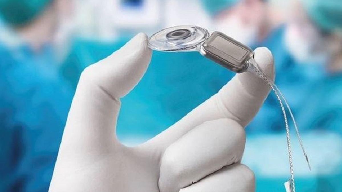 En San Juan se realizaron 50 cirugías de implante coclear en 15 años